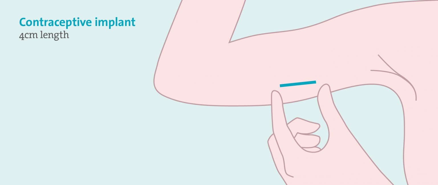 Long Acting Reversible Contraception Larcs Phocus On Lifestyle